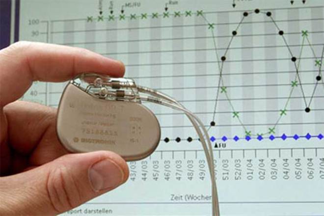 Smallest pacemaker implanted on Northeast man for first time - India ...