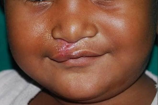 Bring back the smile: Tackling cleft in India, one doctor at a time ...
