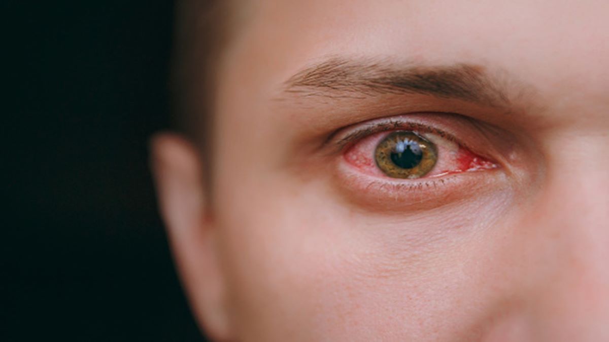 Eye Flu cases increase in India; Know its causes, symptoms and ...
