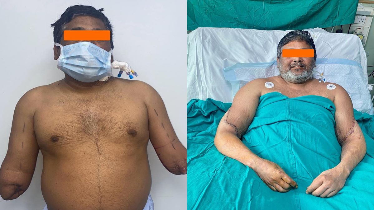 Man who lost his hands in train accident gets new pair with rare ...