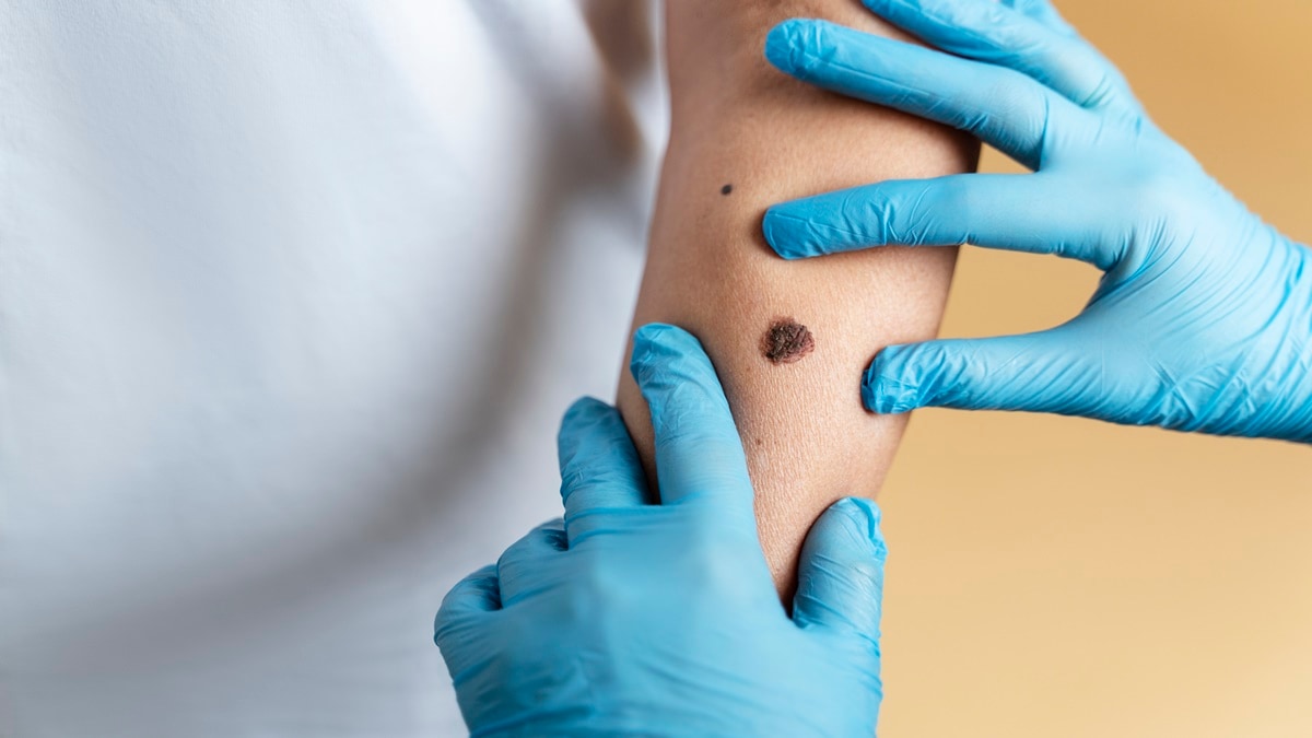 Mpox vs Smallpox: What is the difference? Know all about symptoms and ...