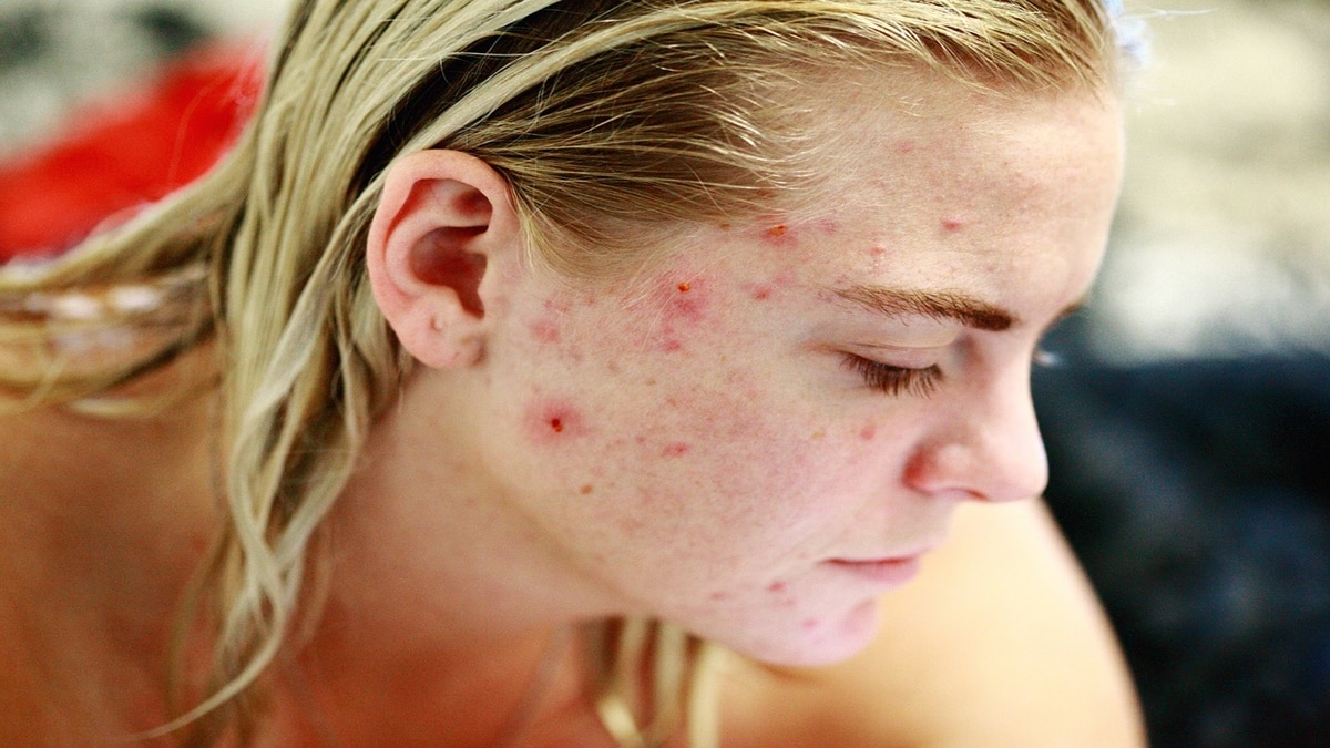 Acne a sign of cancer? How your flare ups can lead to disastrous ...