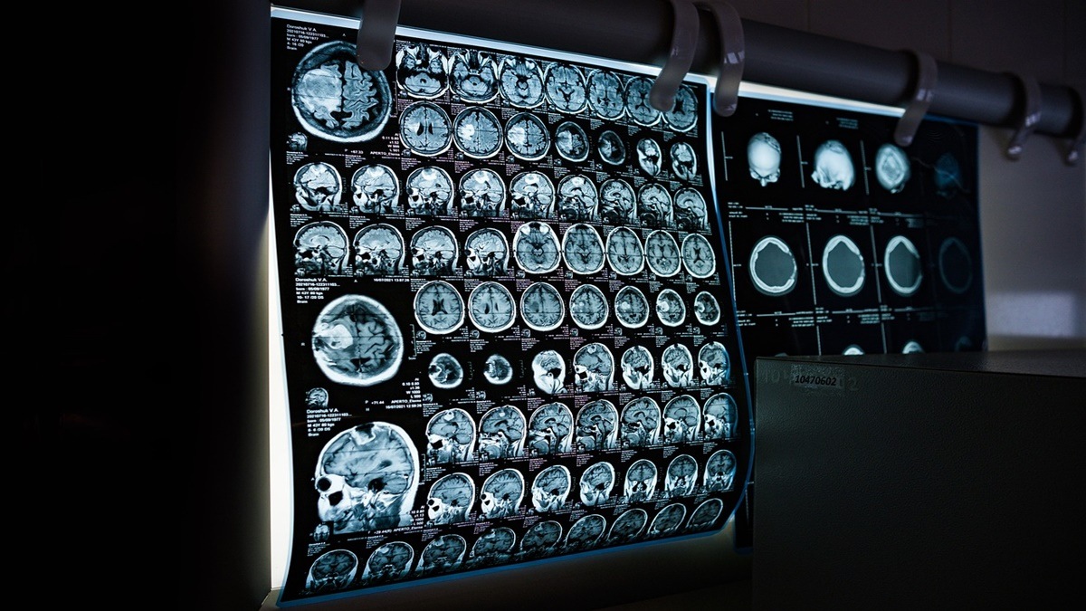 How does HMPV infection affects brain? Symptoms, complications and ...